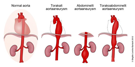 Torakalt aortaaneurisme, størrelse, prognose - NHI.no