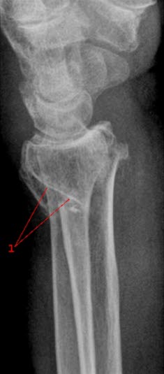 Radiusfraktur, side - NHI.no