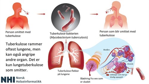 Tuberkulose, lunge, oversikt - NHI.no