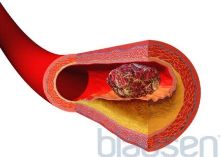 Trombose og blodpropp - NHI.no