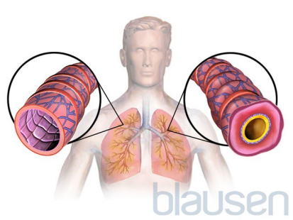 Type 2 inflammasjon - NHI.no