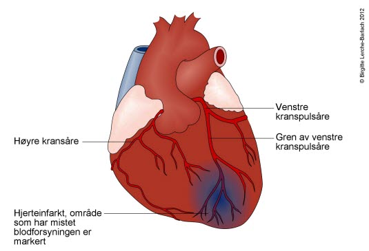 Hjertet - Koronararteriene - NHI.no