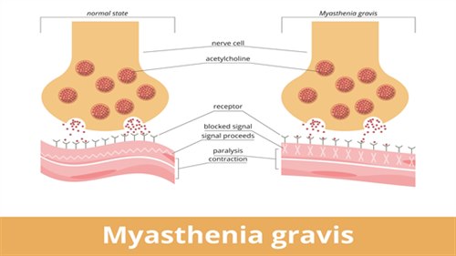 Rituksimab ved nyoppstått myasthenia gravis - NHI.no