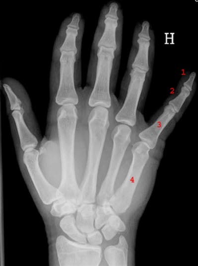 Fingerbrudd - NHI.no
