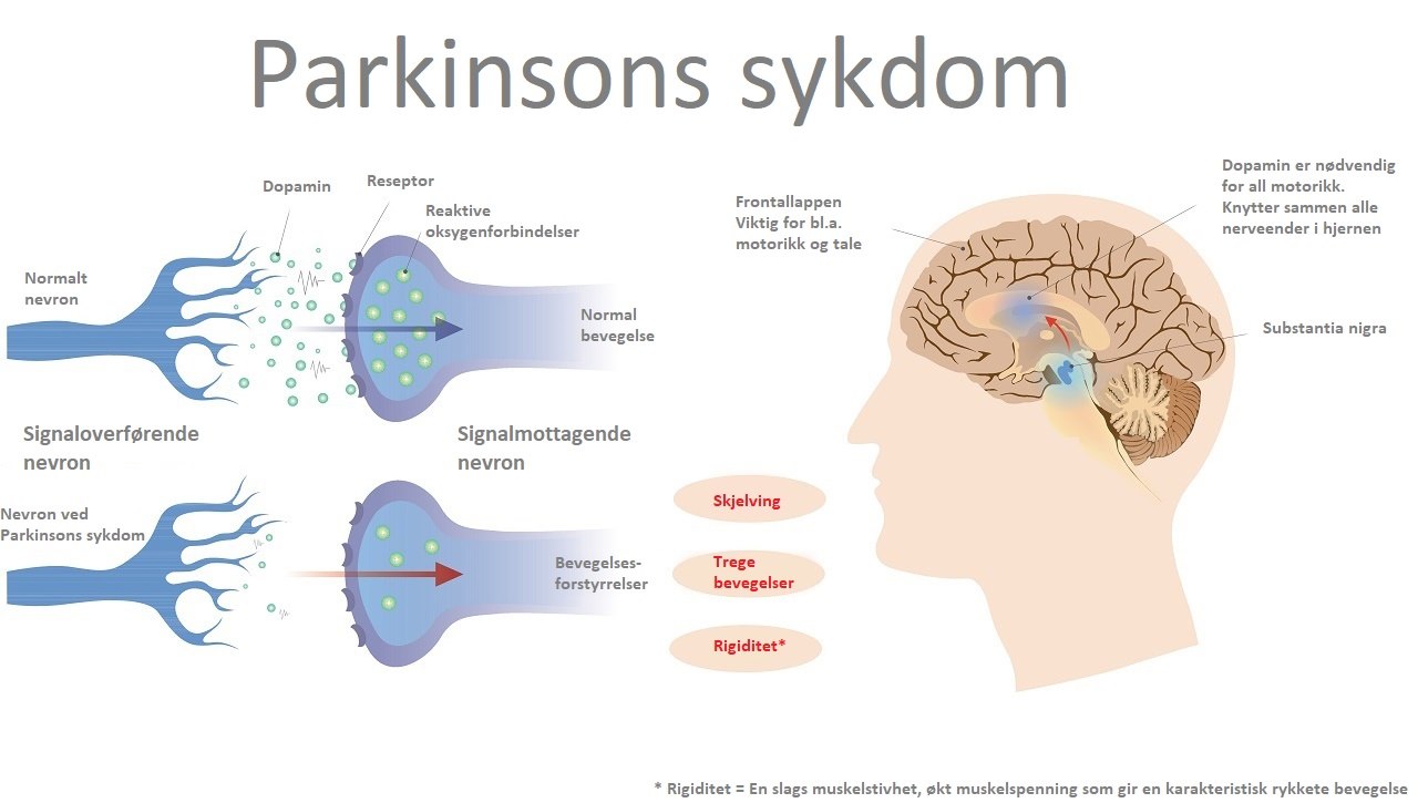 Parkinsons sykdom - quiz - NHI.no