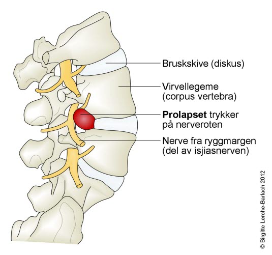 Lumbalt skiveprolaps - sidebilde - NHI.no