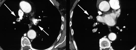 Blodpropp i lungene (lungeemboli) - Diagnostikk - NHI.no