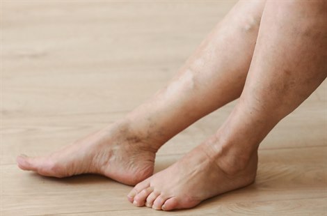 DOACs i behandlingen av overflatisk venetrombose - NHI.no